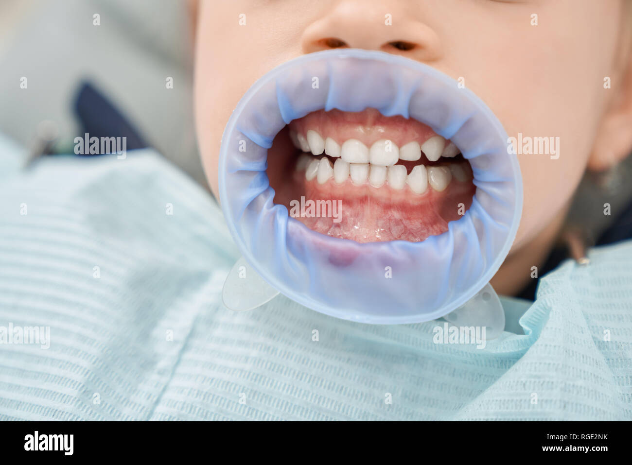 Closeup of white teeth of little patient after whitening procedure in ...