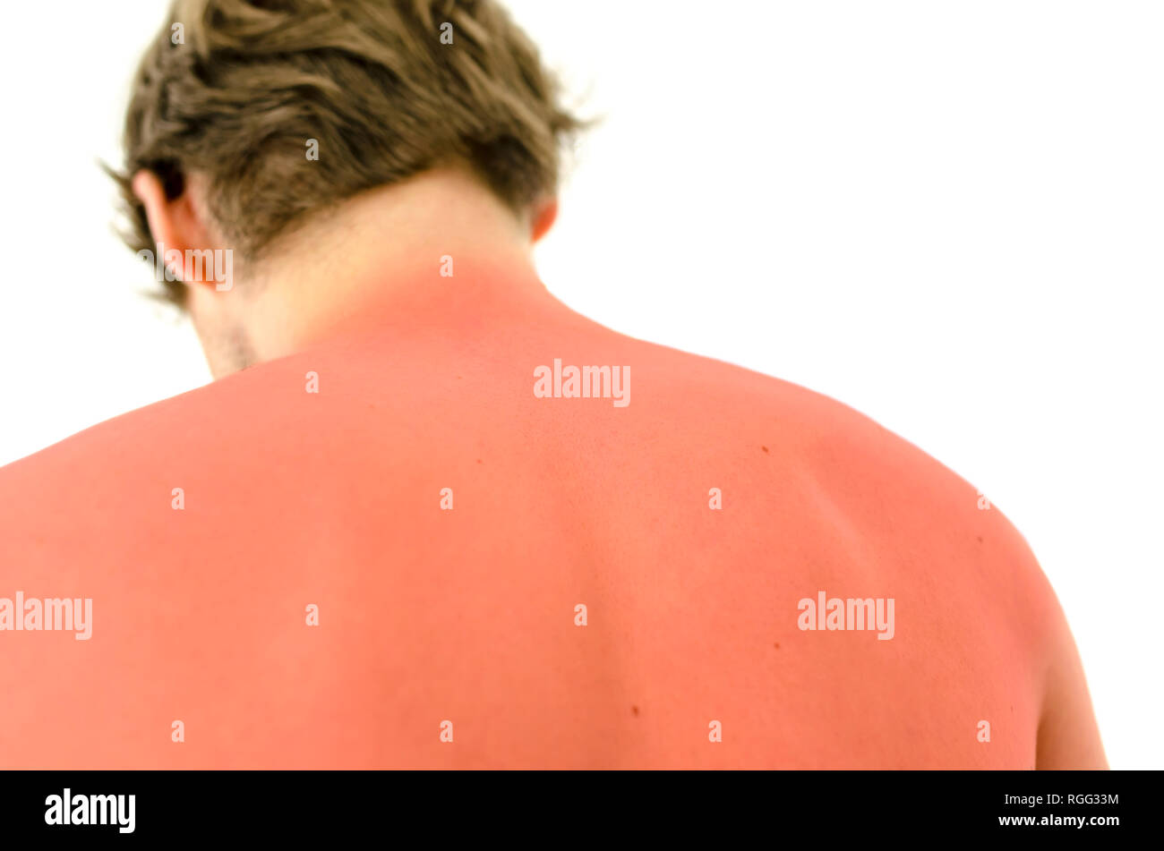 Sunburned male back. Isolated over white background Stock Photo - Alamy