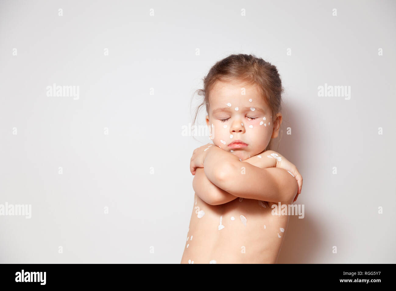 Closeup cute little girl with varicella virus or chickenpox bubble rash ...