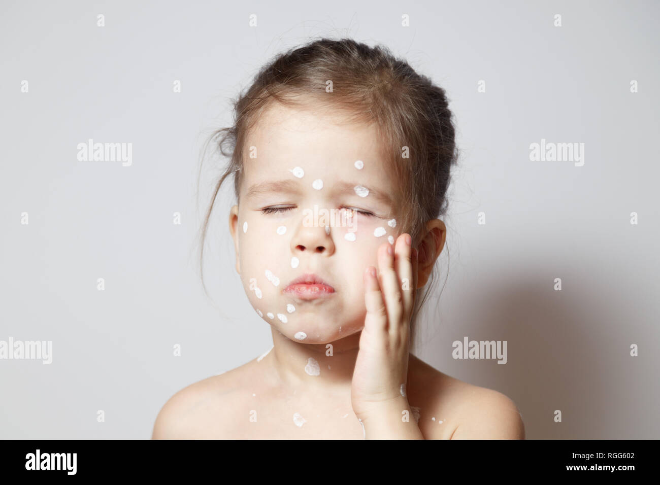Closeup cute little girl with varicella virus or chickenpox bubble rash ...
