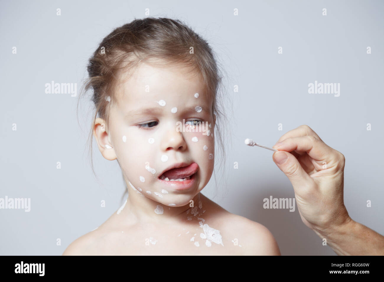 Closeup face of cute little girl with varicella virus or chickenpox ...