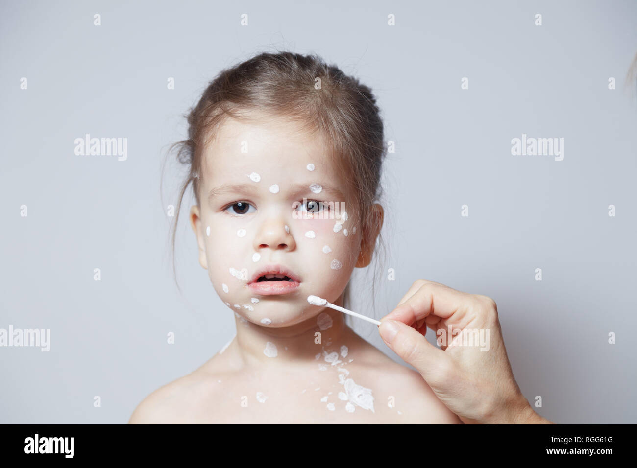 Closeup face of cute little girl with varicella virus or chickenpox ...