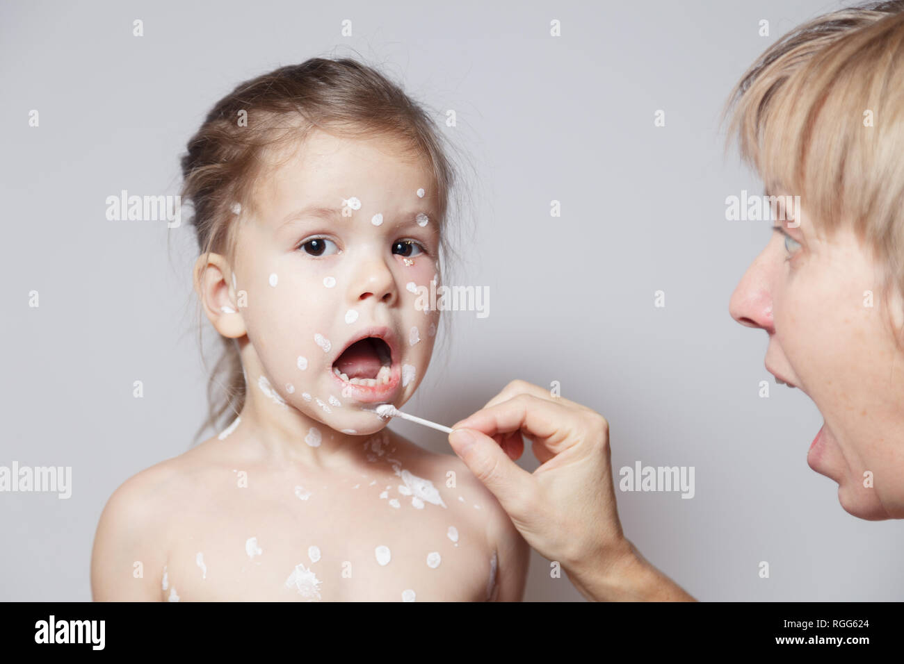 Closeup face of cute little girl with varicella virus or chickenpox ...