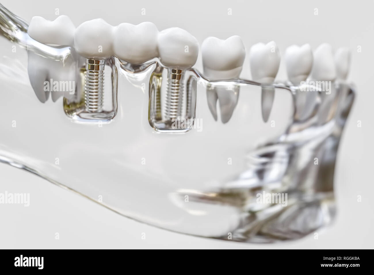 Tooth human implant - 3D Rendering Stock Photo - Alamy