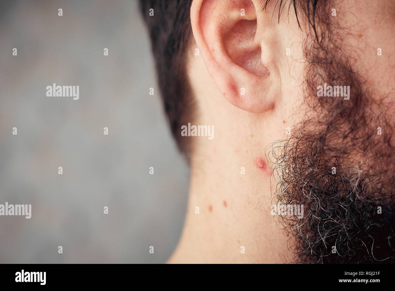festering pimple on a man's neck,the bearded man has problems with skin ...
