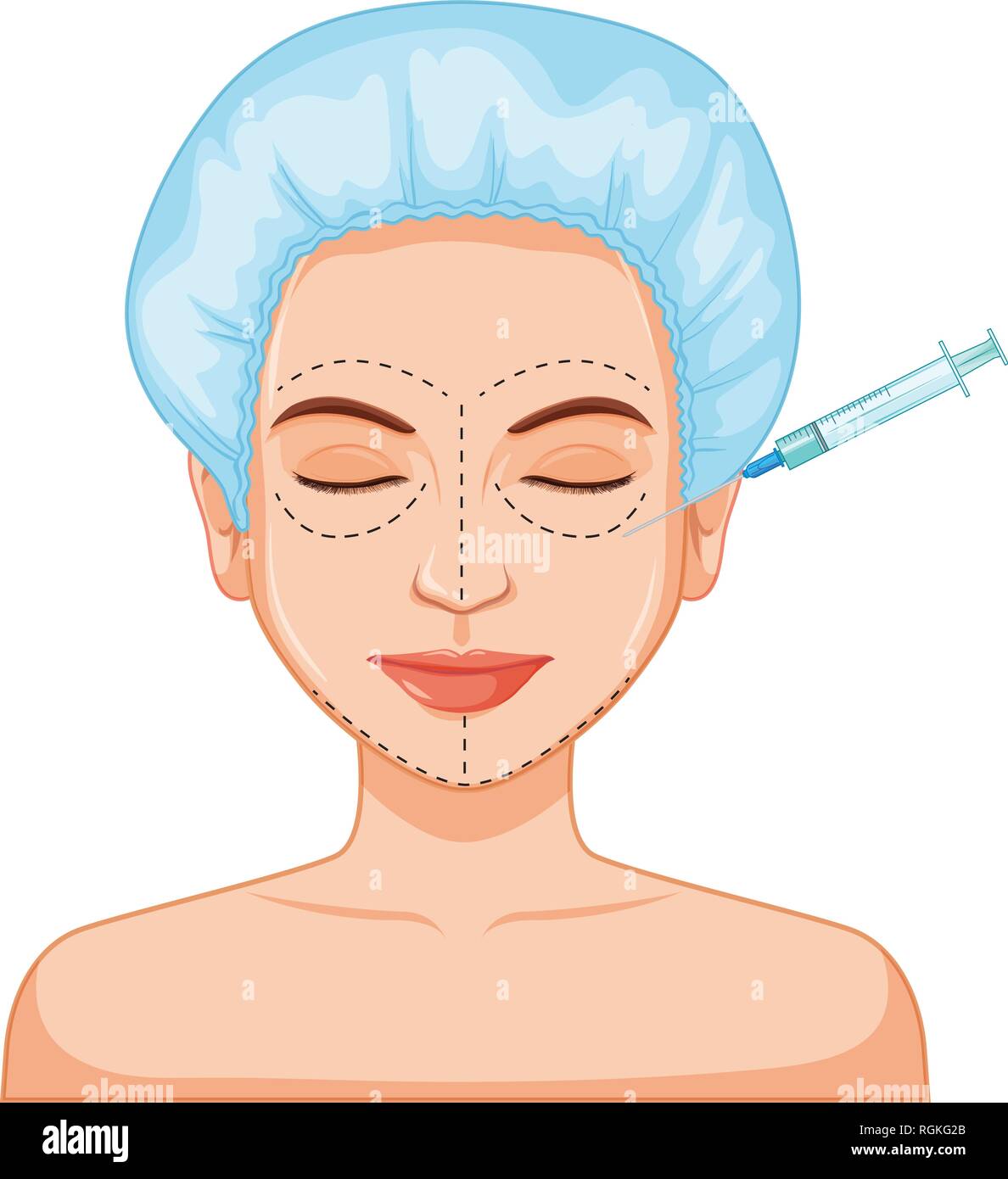 Woman botox filler skin injection illustration Stock Vector Image & Art ...