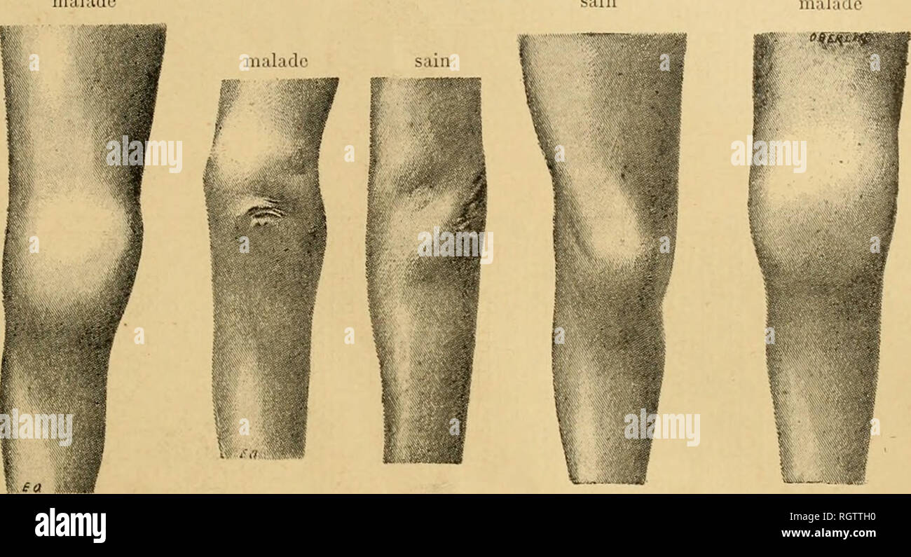 Avant bras gauche hi-res stock photography and images - Alamy