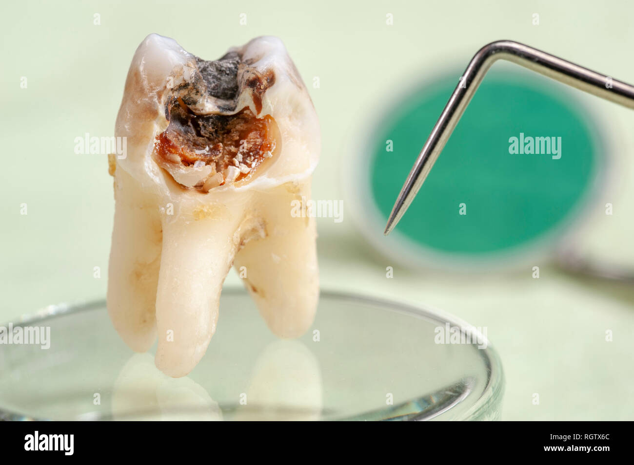 Molar tooth decay hi-res stock photography and images - Alamy