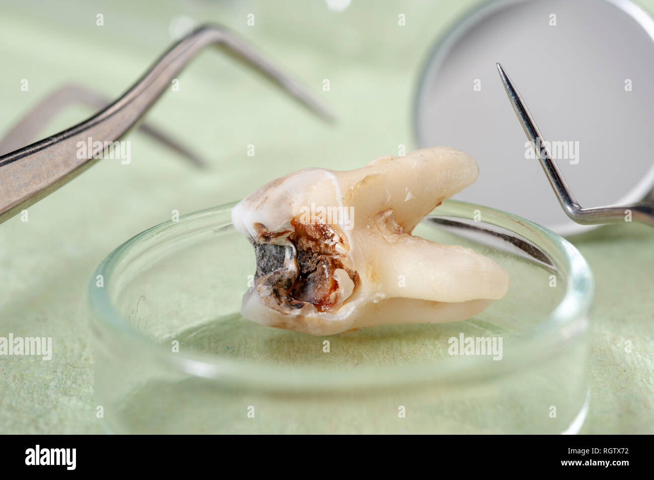 Dental caries decay hi-res stock photography and images - Alamy