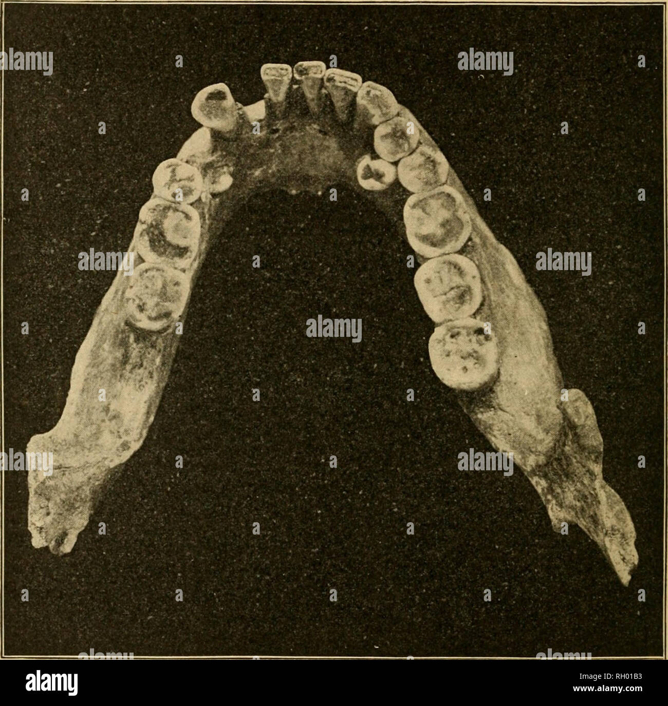 Human lower jaw missing teeth hi-res stock photography and images - Alamy
