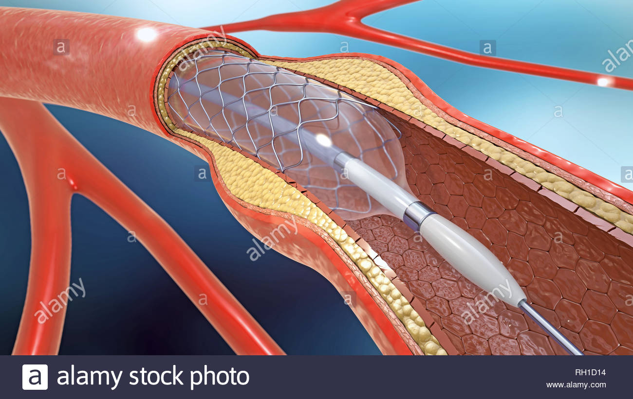 Coronary Stent Stock Photos & Coronary Stent Stock Images - Alamy