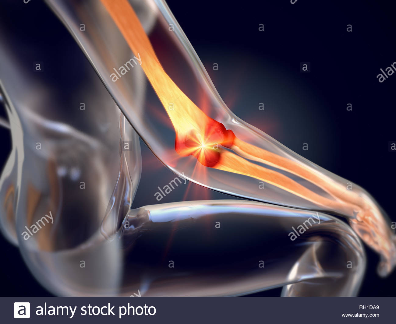 Epicondylitis Stock Photos & Epicondylitis Stock Images - Alamy