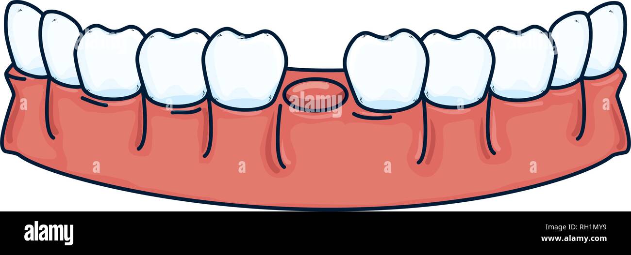 human teeth without one tooth Stock Vector Image & Art - Alamy