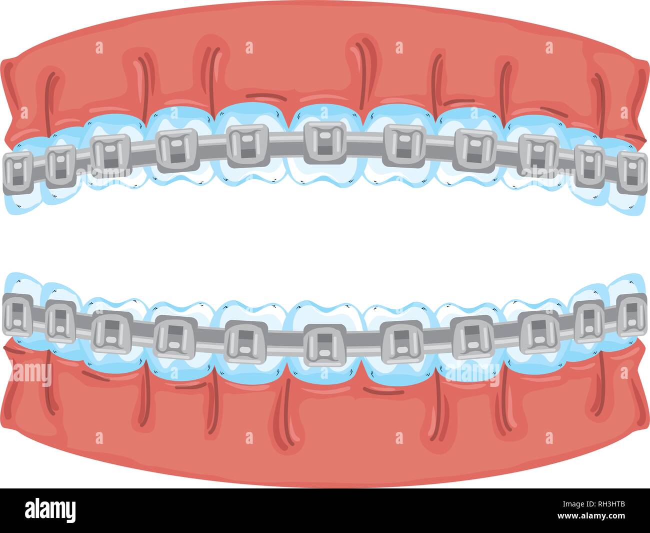 human teeth with orthodontics Stock Vector Image & Art - Alamy