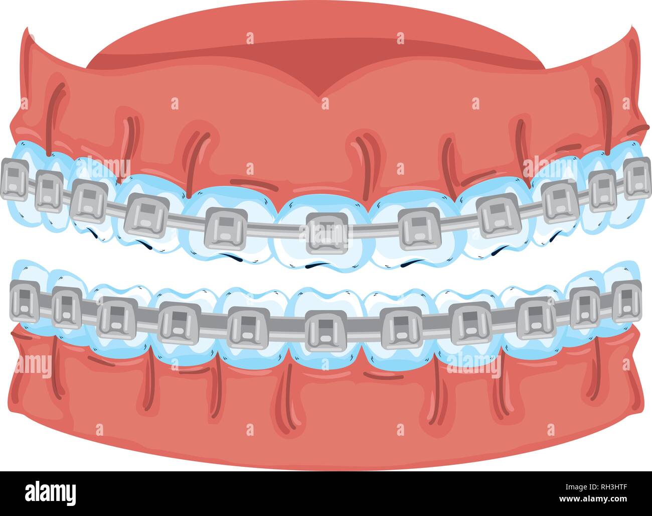 human teeth with orthodontics Stock Vector Image & Art - Alamy