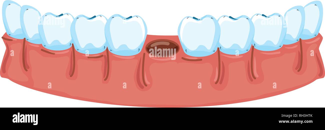 human teeth without one tooth Stock Vector Image & Art - Alamy