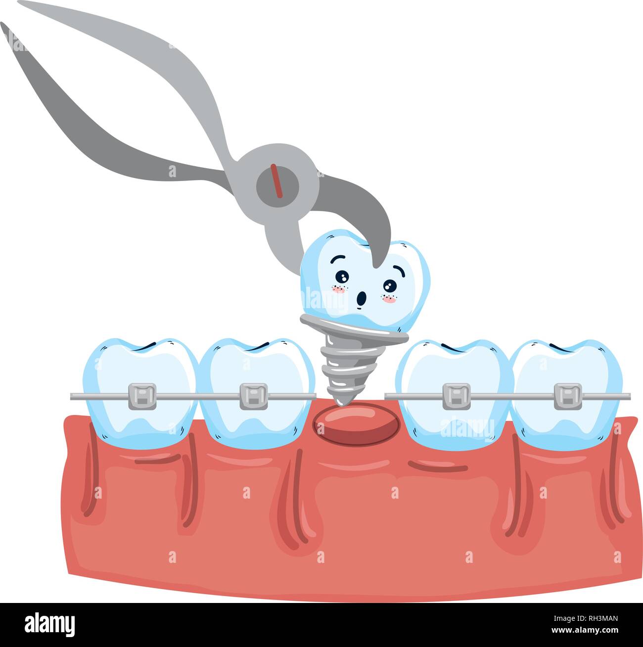 human teeth with pliers extracting implant Stock Vector Image & Art - Alamy