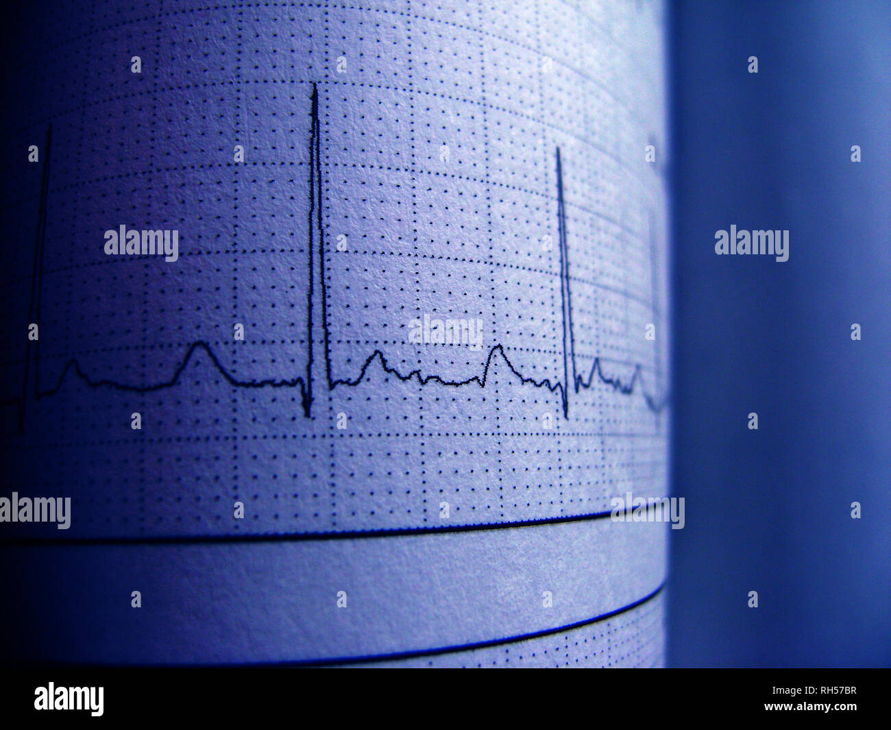 Sinus Heart Rhythm On Electrocardiogram Record Paper Showing Normal P ...