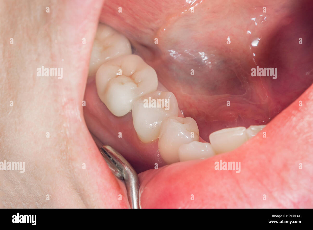 Roots of teeth hi-res stock photography and images - Alamy