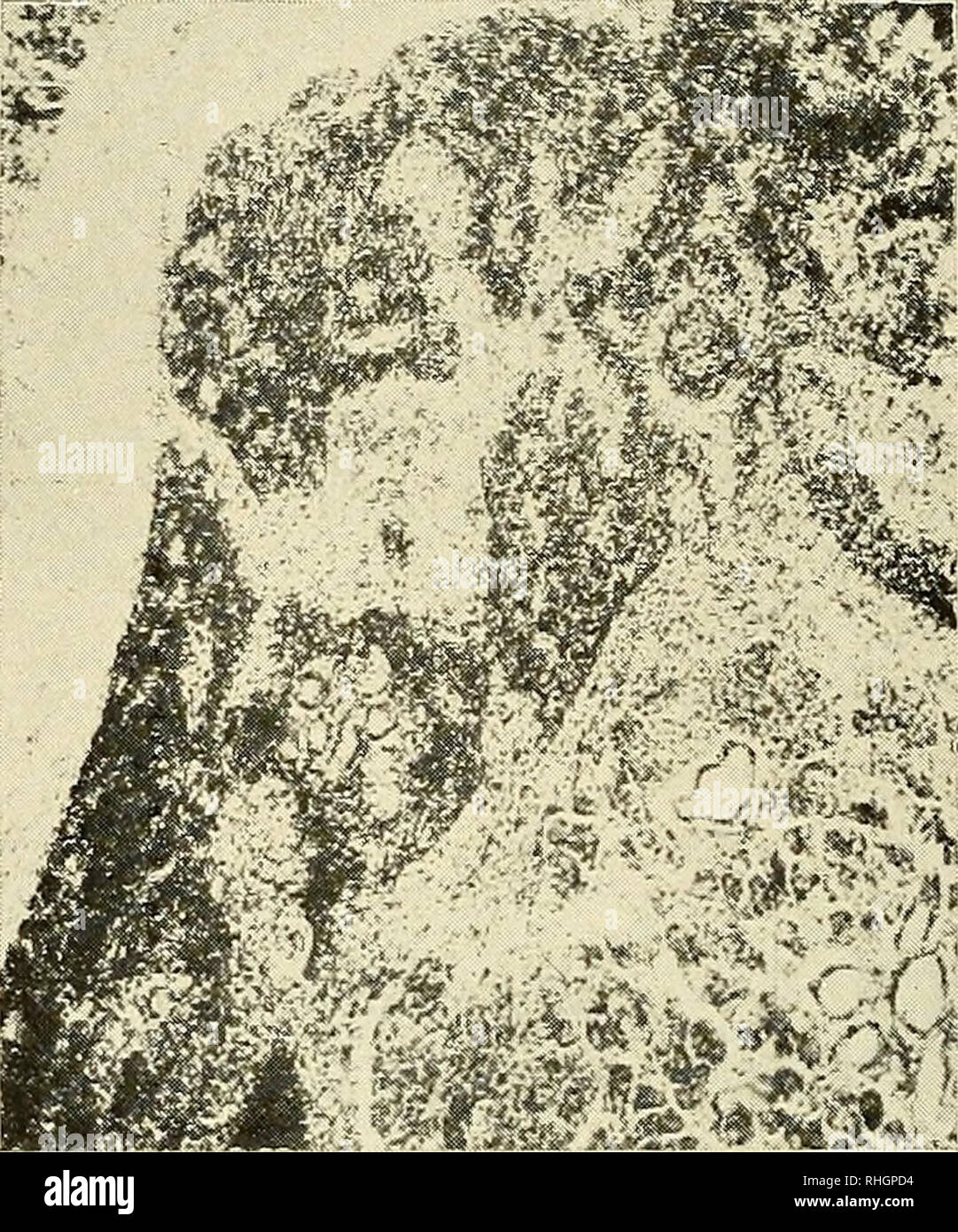 Linfadenitis aguda hi-res stock photography and images - Alamy