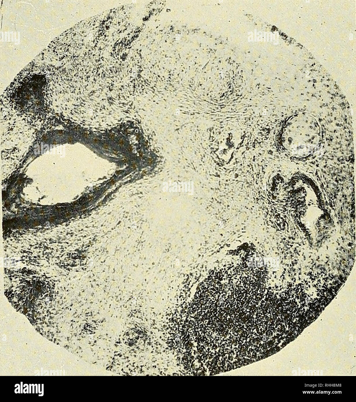 Tonsila hi-res stock photography and images - Alamy