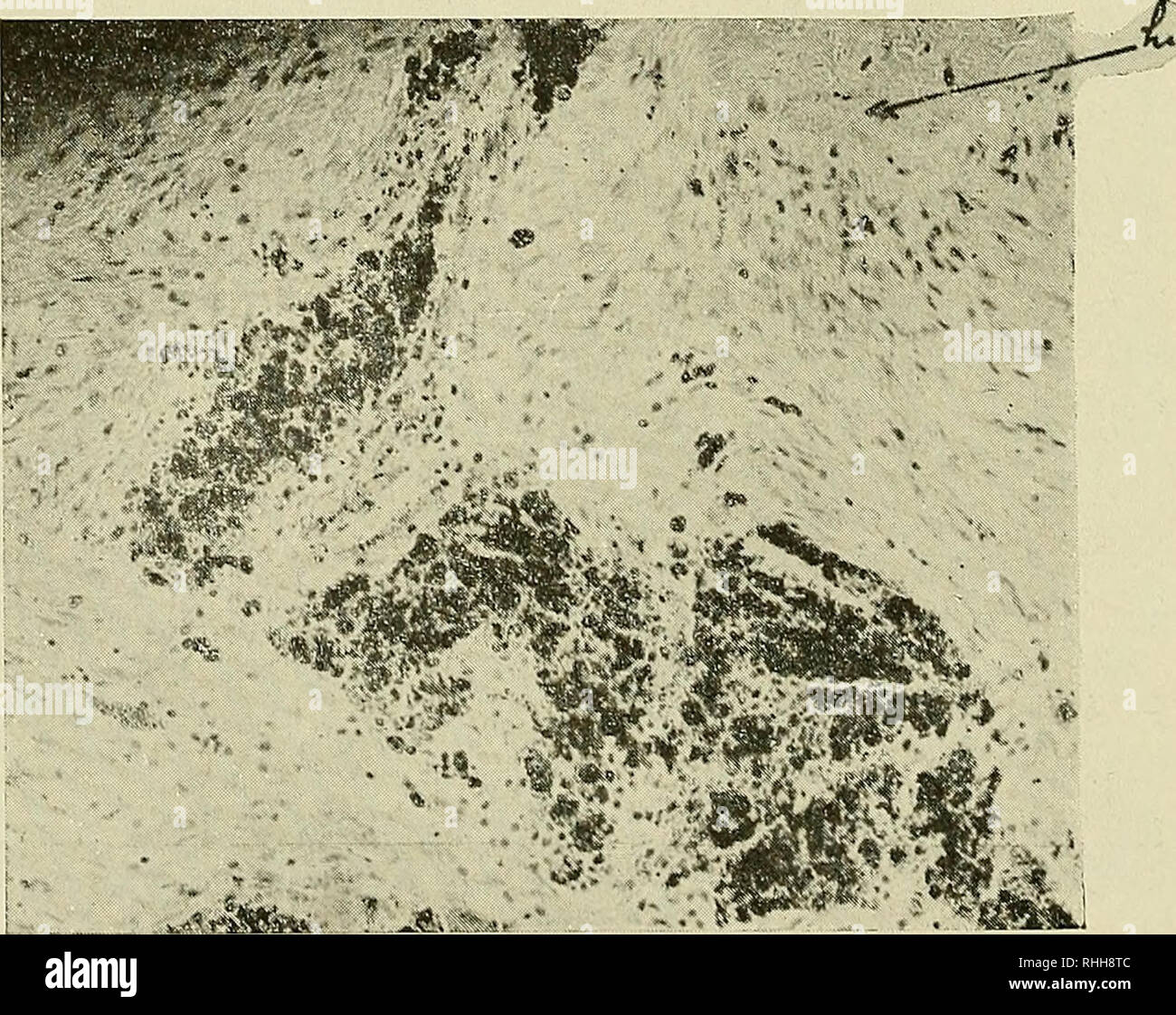 Hemosiderina hi-res stock photography and images - Alamy