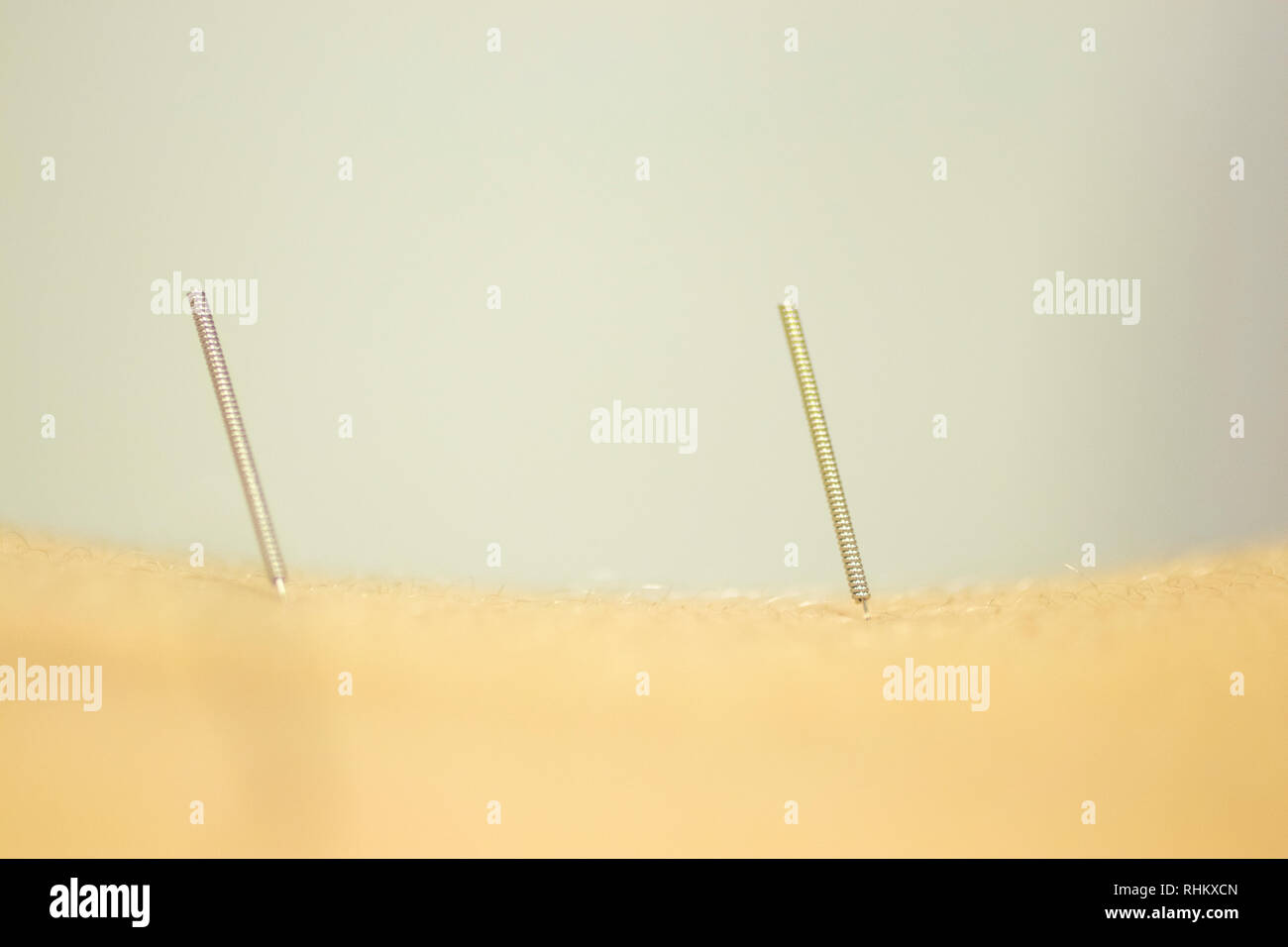 Physiotherapy clinic Intratissue Percutaneous Electrolysis EPI dry ...