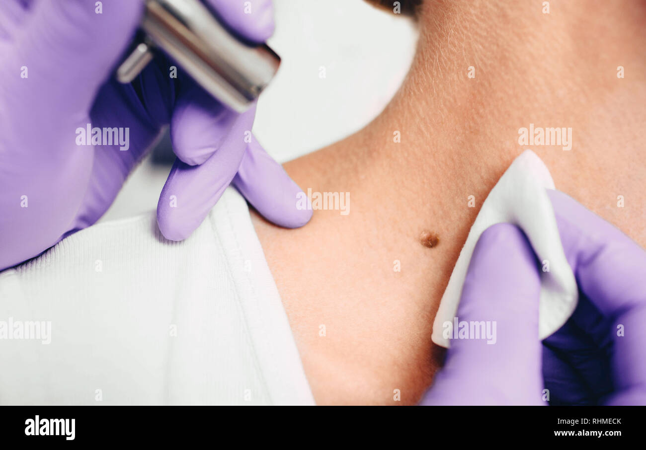 Skin cancer melanoma mole hi-res stock photography and images - Alamy