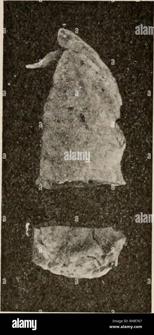 Calcified fetus hi-res stock photography and images - Alamy