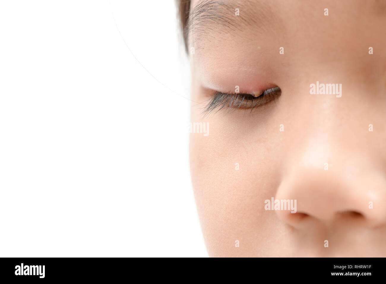 Close up of asian little girl one eye infection isolated on white ...