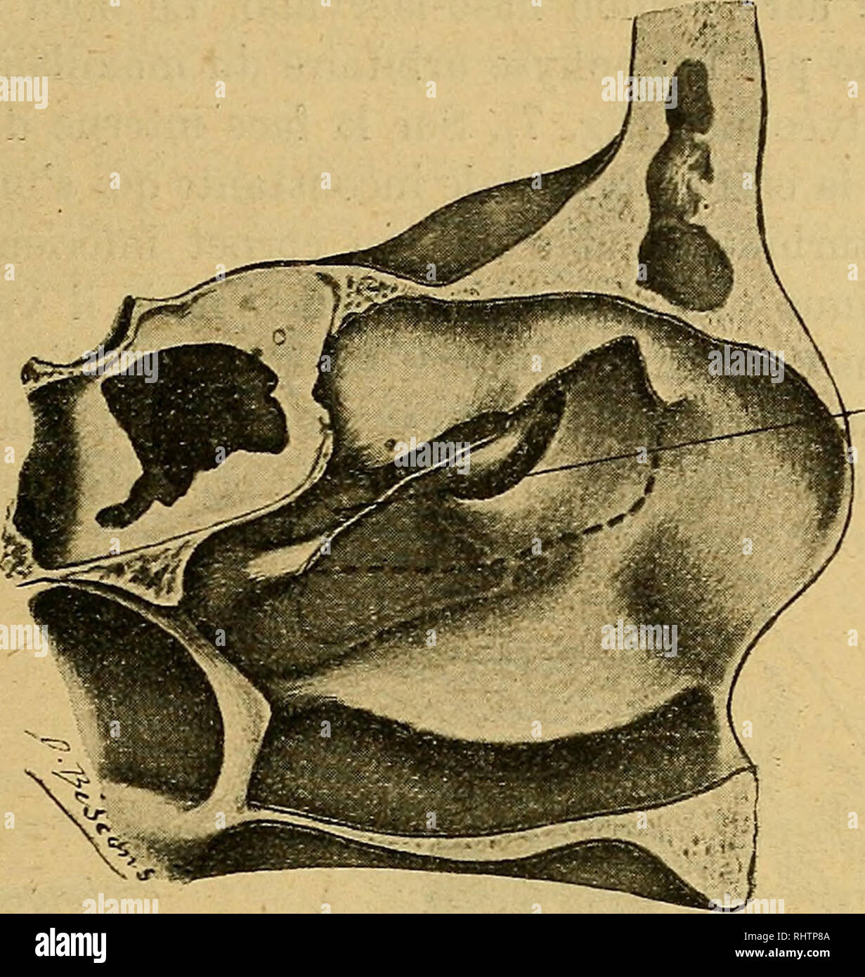 Sinus maxillaire hi-res stock photography and images - Alamy