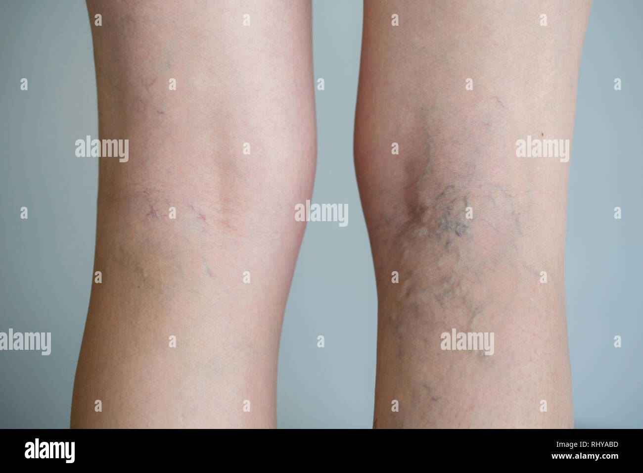 Painful varicose veins (spider veins, varices) on a severely affected ...