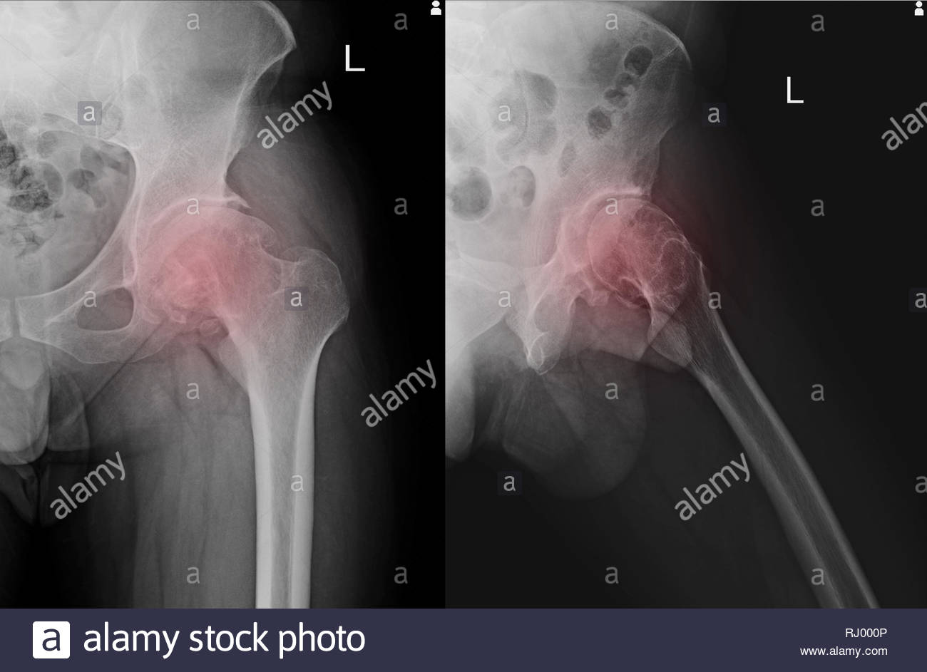 Hip Osteoarthritis X Ray Stock Photos & Hip Osteoarthritis X Ray Stock ...