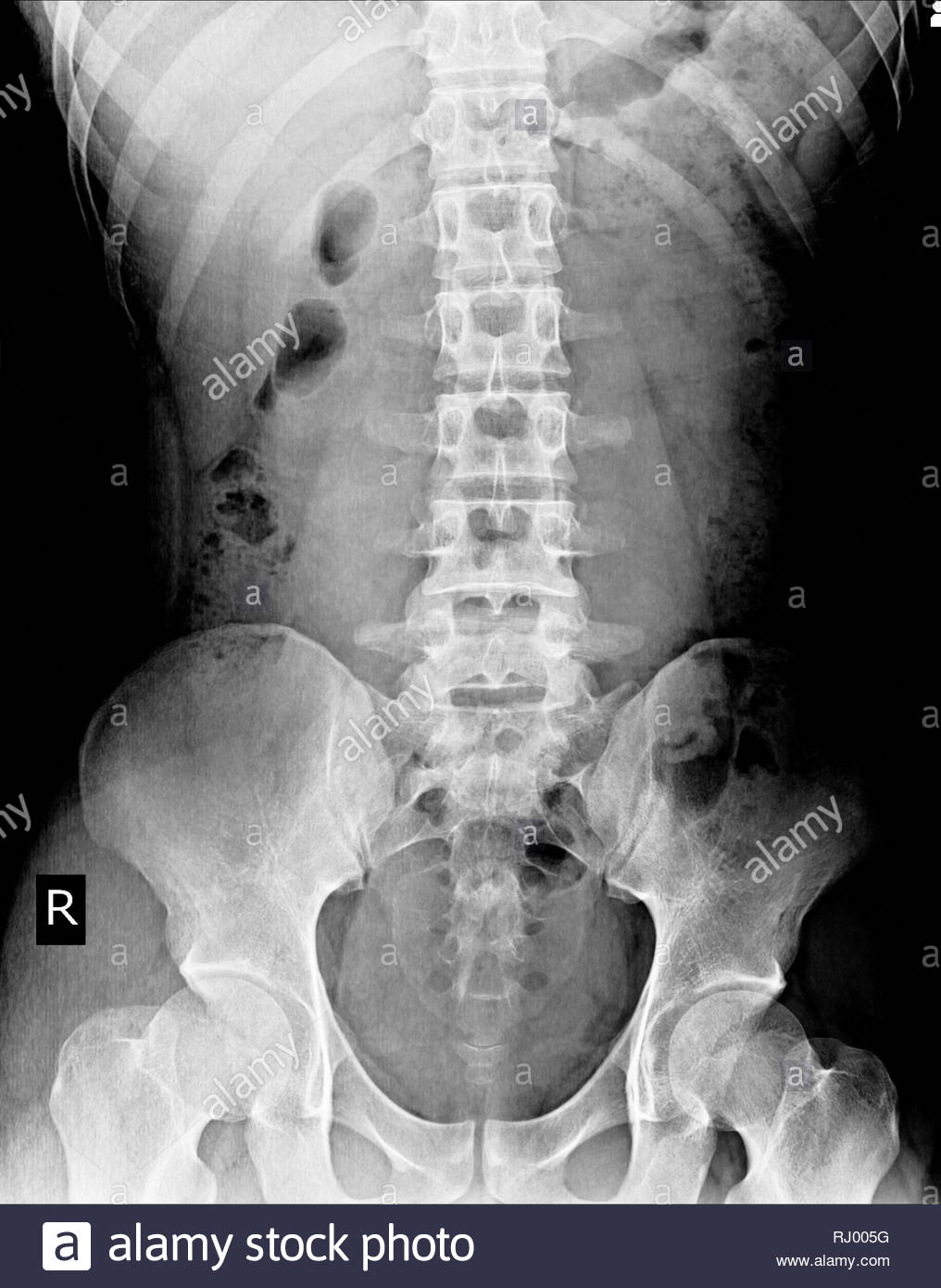 Compression Fracture Spine Stock Photos & Compression Fracture Spine ...