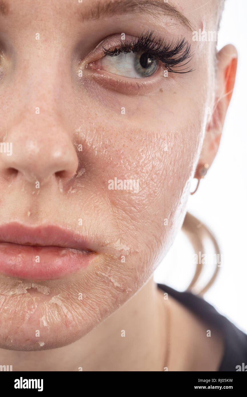 female face with burned skin after chemical peeling Stock Photo - Alamy