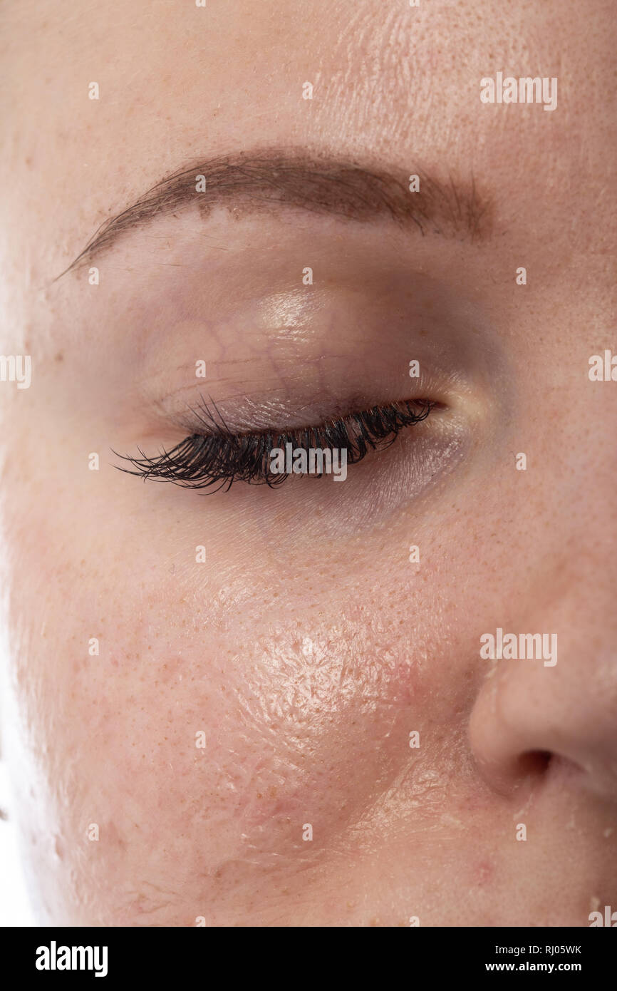 Burned Skin Stock Photos & Burned Skin Stock Images - Alamy