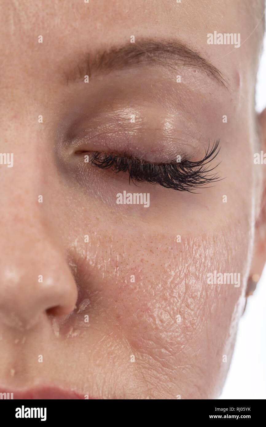 female face with burned skin after chemical peeling Stock Photo - Alamy