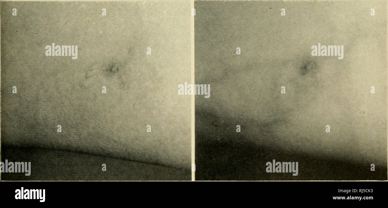 Skin lesions black skin hi-res stock photography and images - Alamy