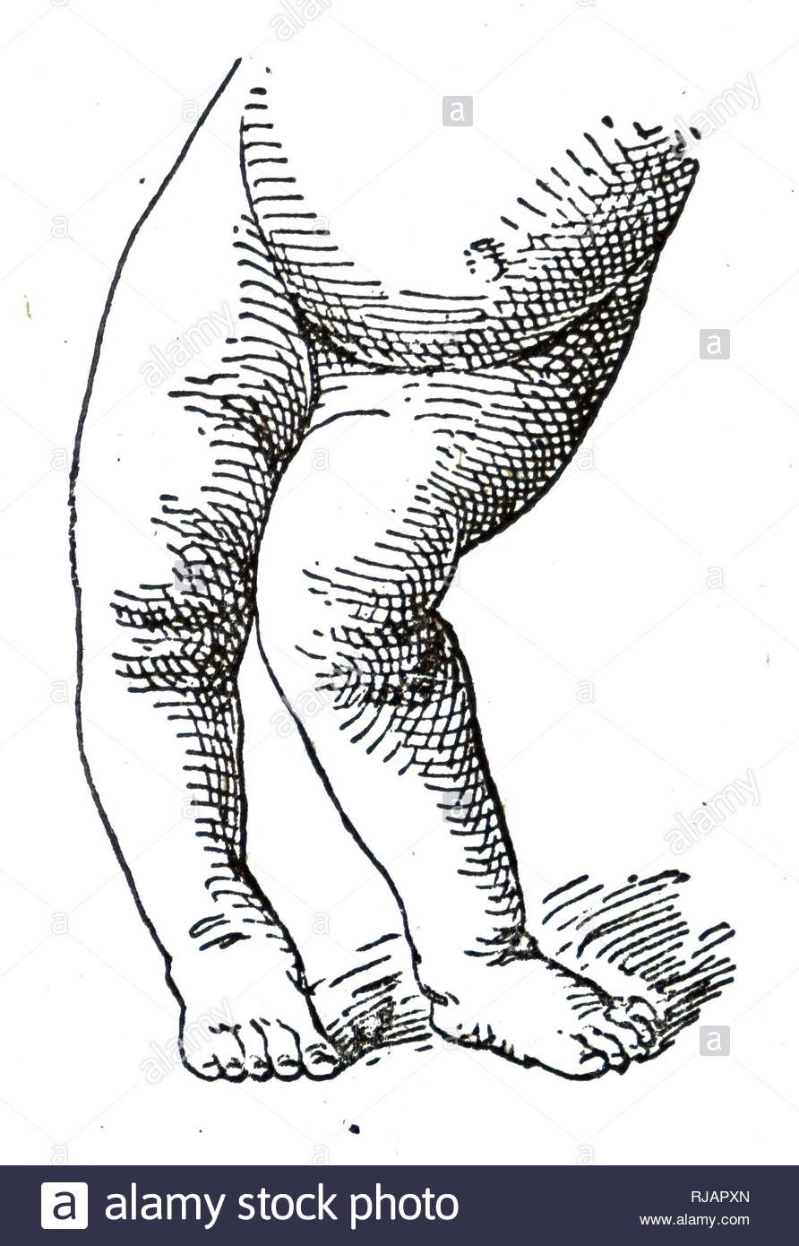 Rickets Child Stock Photos & Rickets Child Stock Images - Alamy