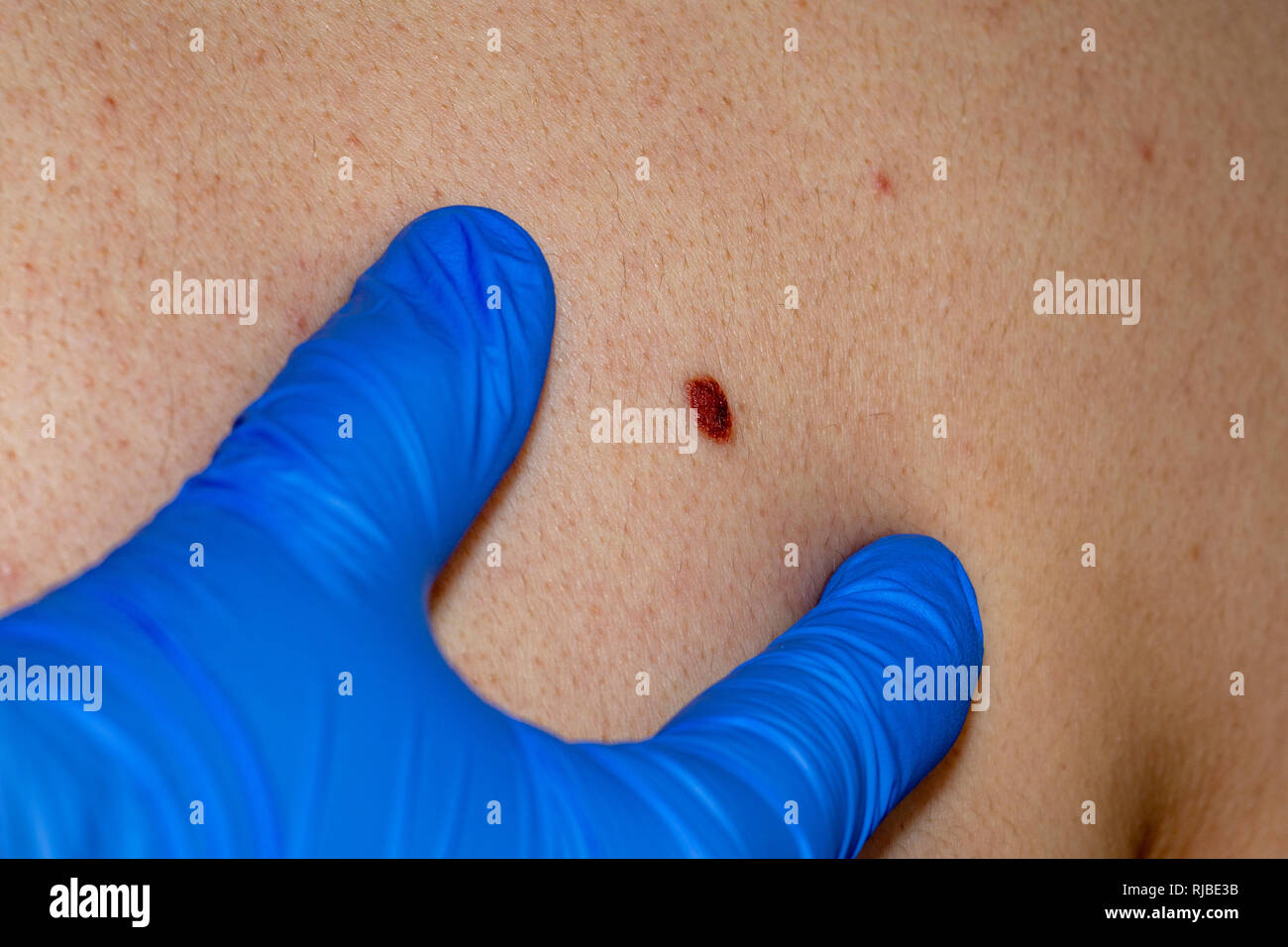 Benign melanoma hi-res stock photography and images - Alamy