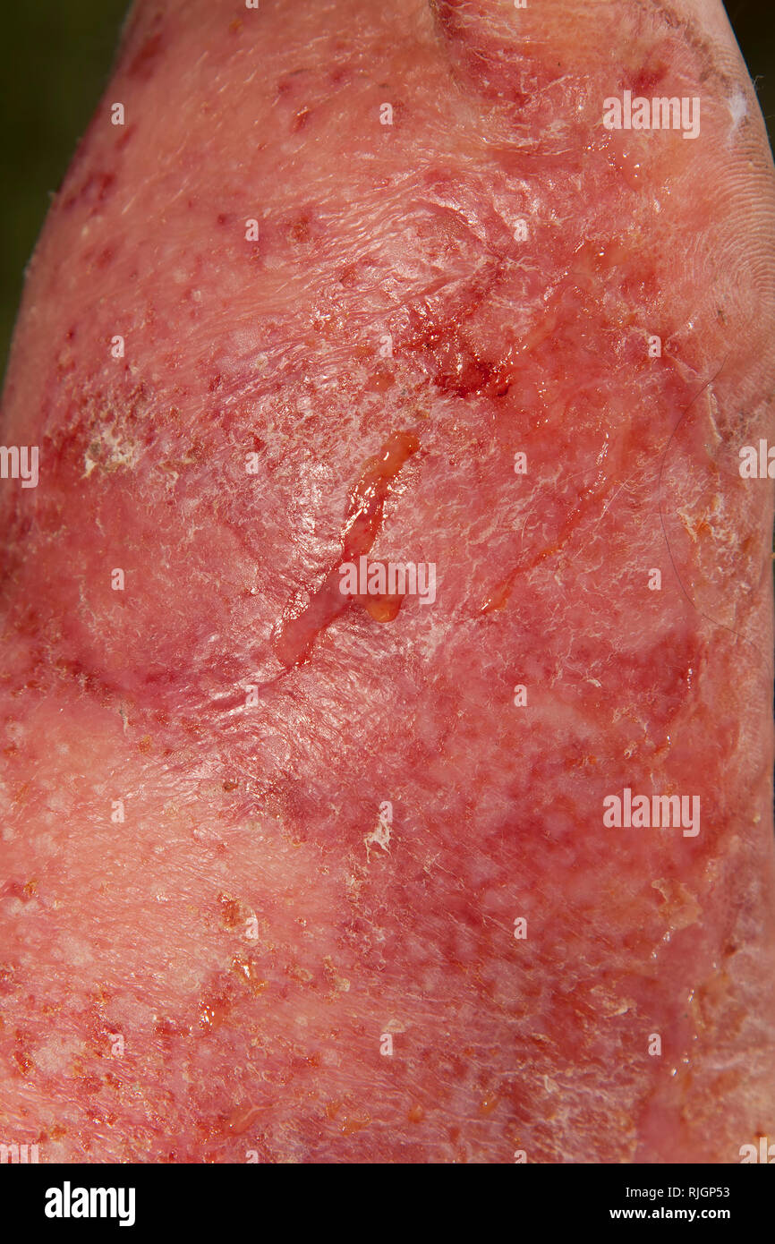 Neurodermatitis National Eczema Association