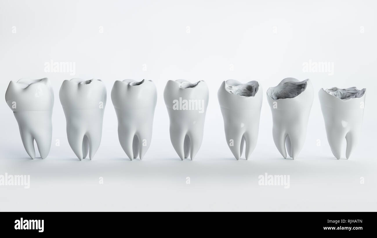 The stages of caries on the molar -- 3D Rendering Stock Photo - Alamy