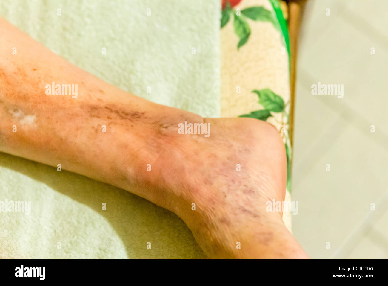 Phlebitis Arm Treatment