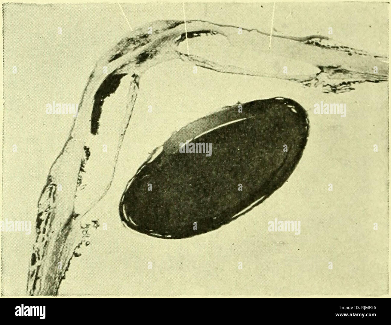 Corneal opacity hi-res stock photography and images - Alamy