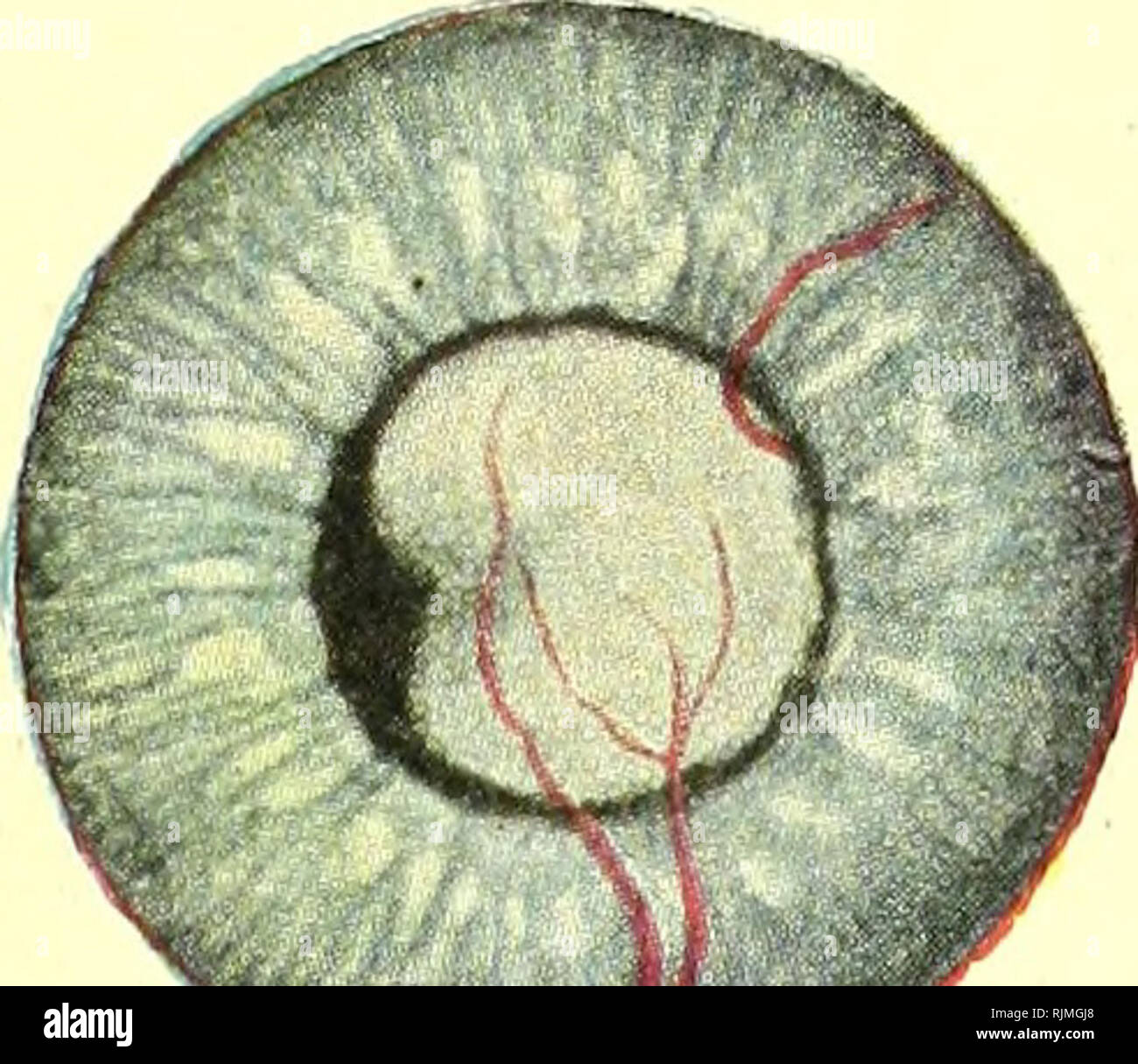 Persistent Pupillary Membrane In Humans