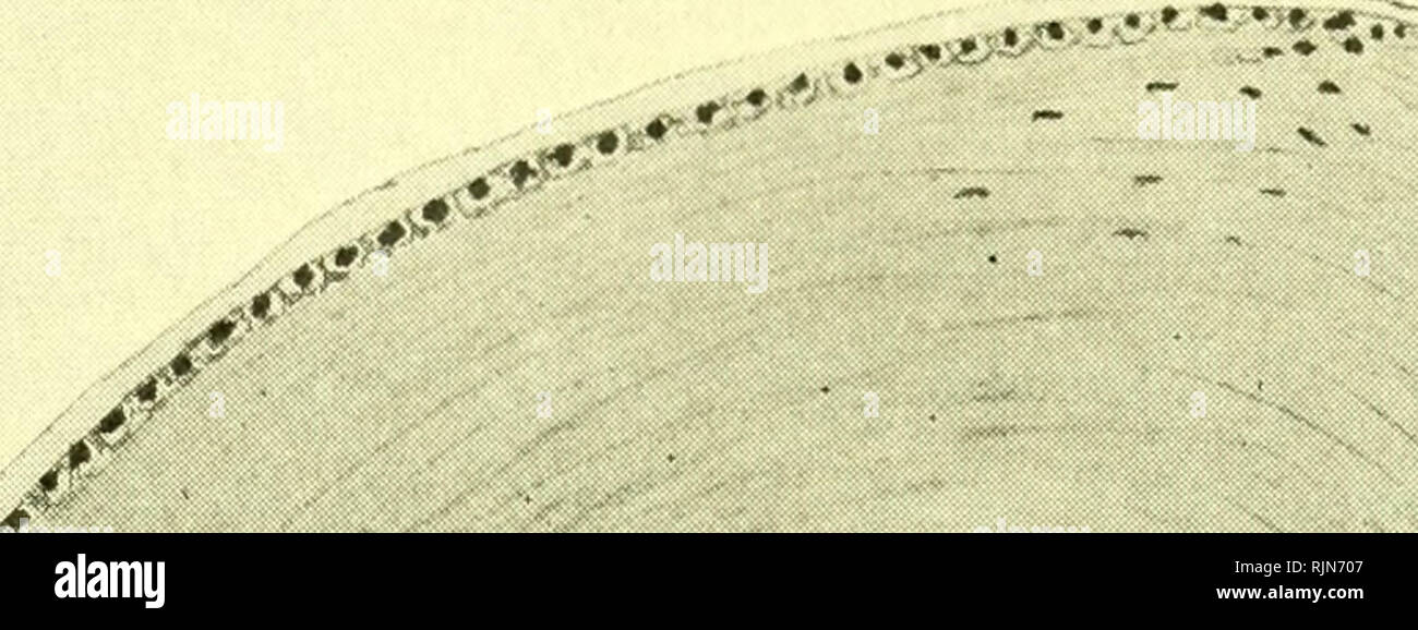 Morgagnian cataract hi-res stock photography and images - Alamy