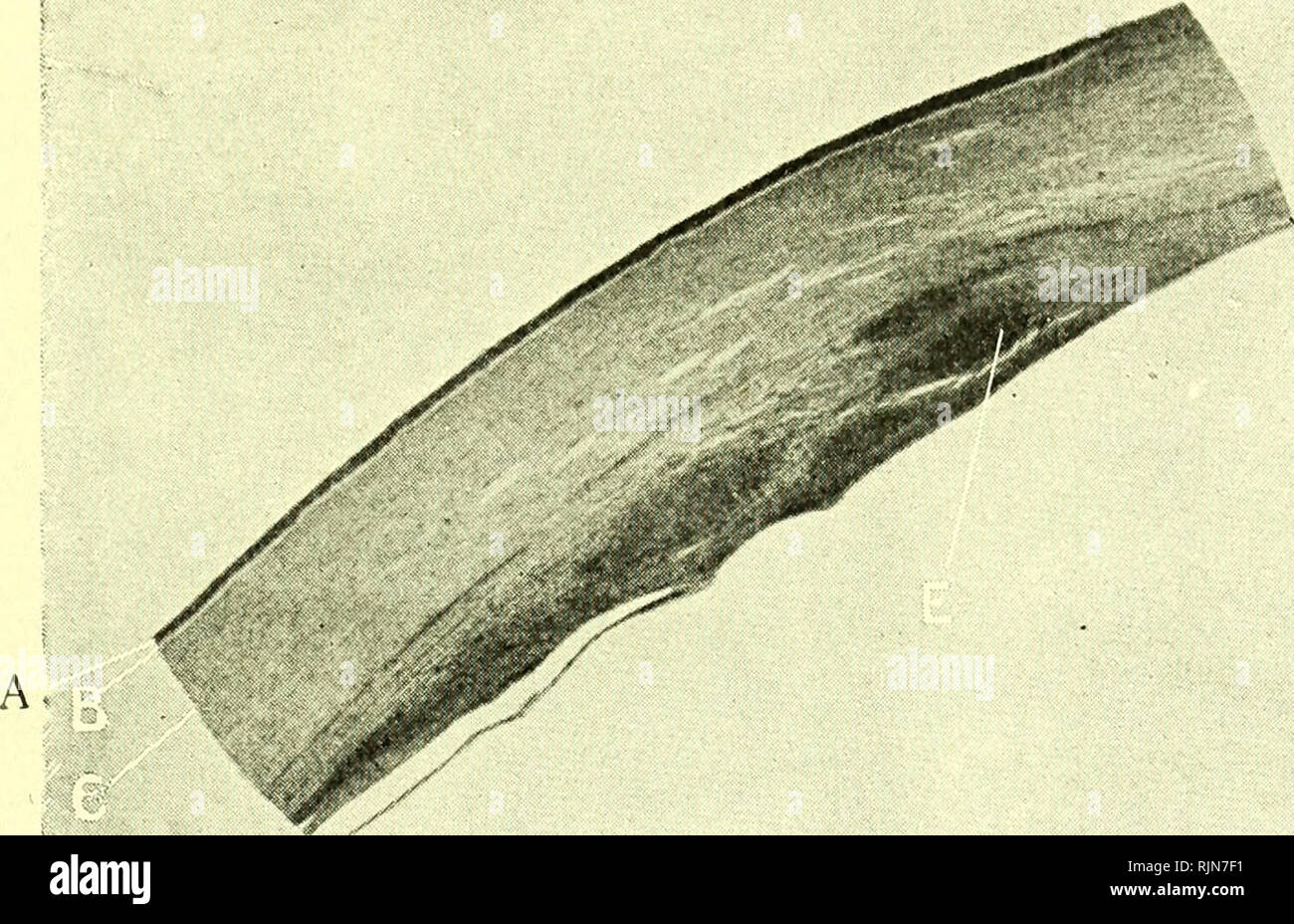 Gummatous syphilis hi-res stock photography and images - Alamy