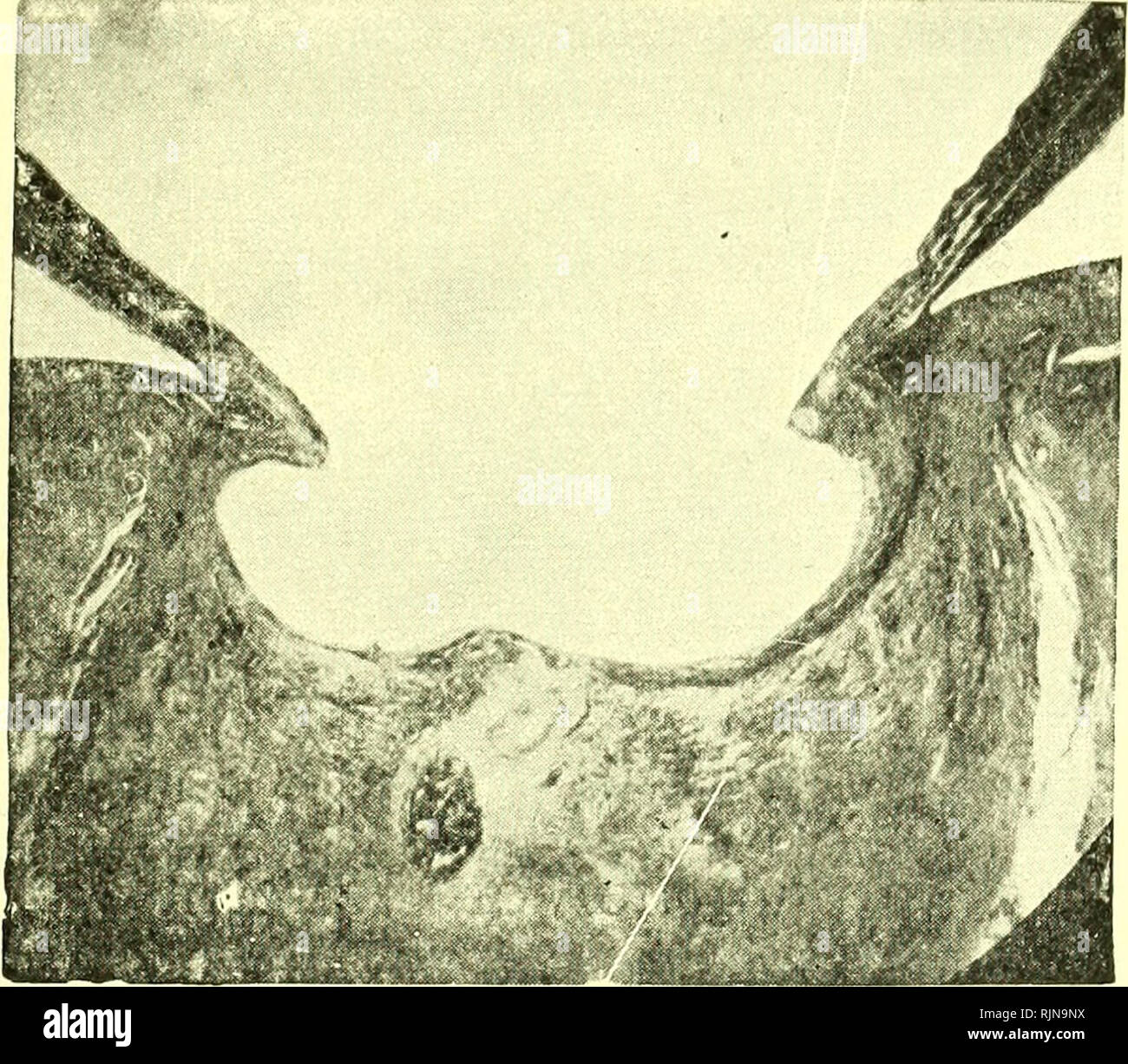 Optic disc cupping hi-res stock photography and images - Alamy