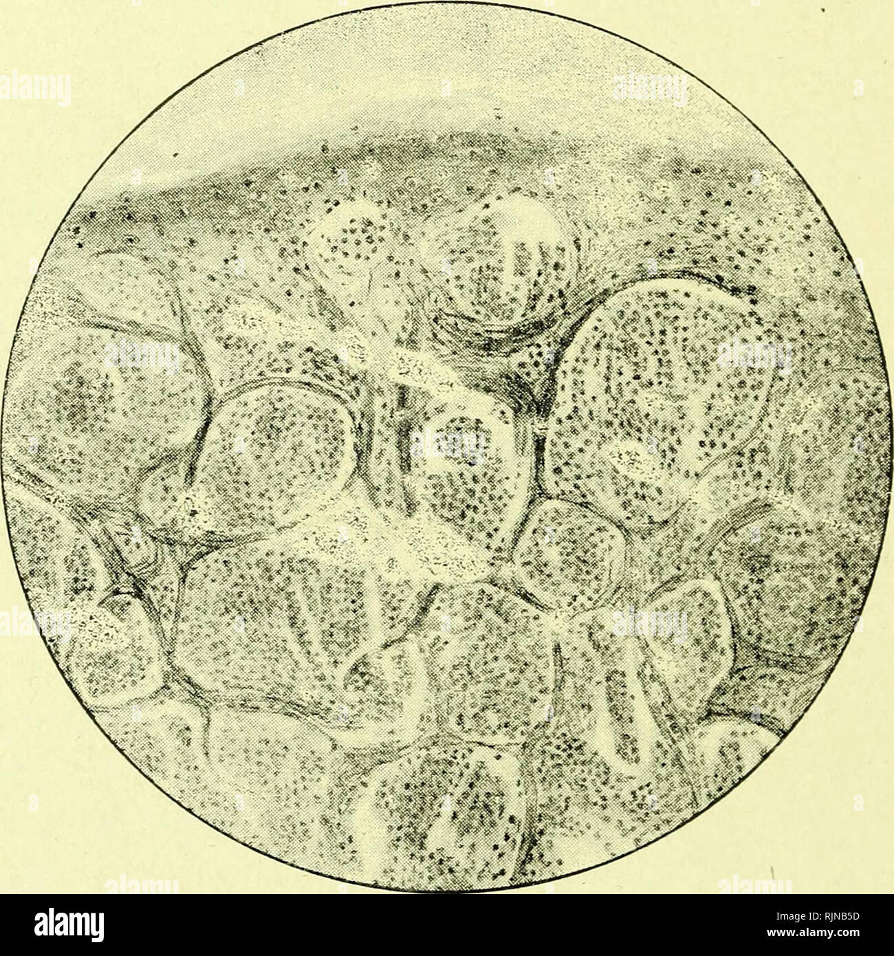 Rare Pathology High Resolution Stock Photography and Images - Alamy