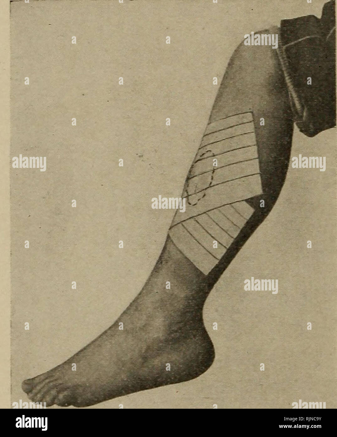 Ulcer Dressing High Resolution Stock Photography and Images - Alamy